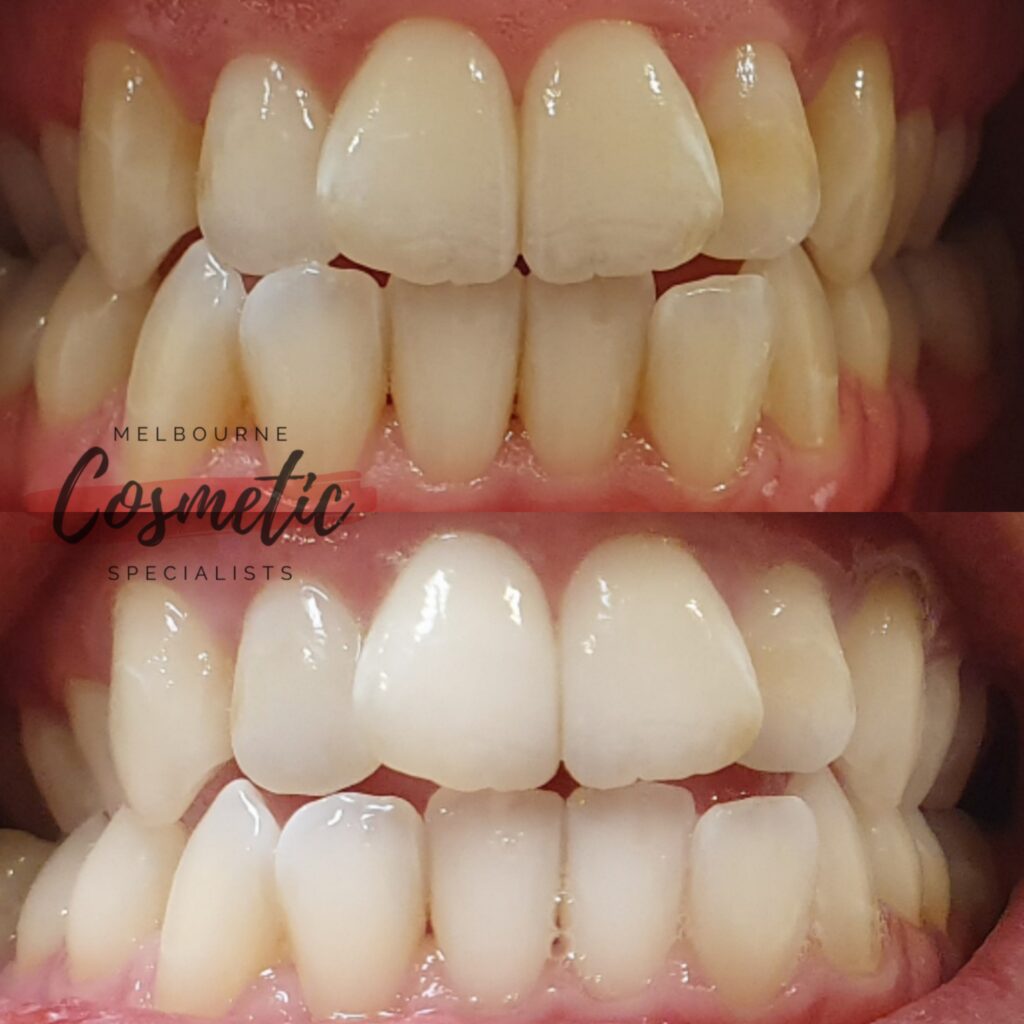 Teeth Whitening - Cosmetic Clinique